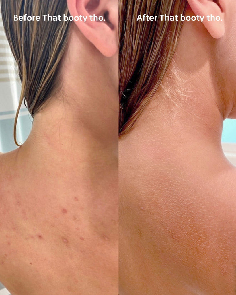 That Booty Tho - The Original Stretch Mark and Cellulite Booty Scrub – Anese.co