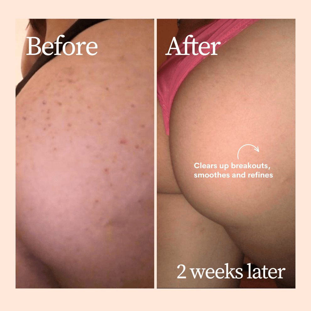 That Booty Tho - Original Stretch Mark & Cellulite Scrub – Anese.co